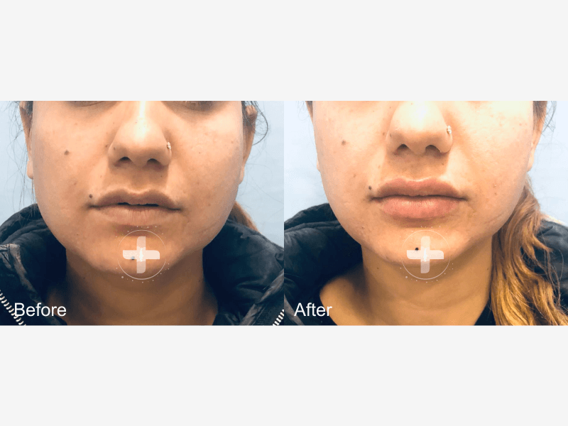 Lip Augmentation in Saket, South Delhi & Gurgaon | Royal Lush Clinic